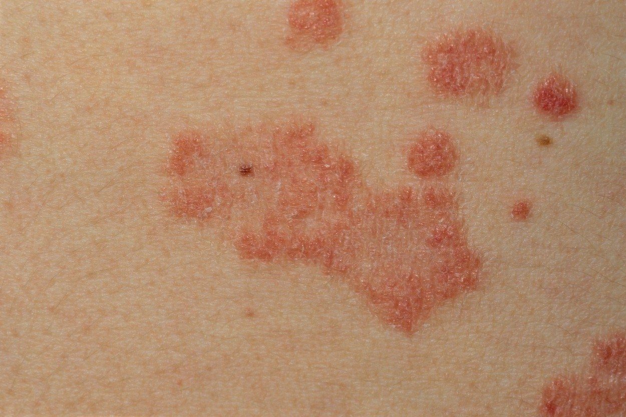 Nevzhledná lupénka není infekční - Novinky